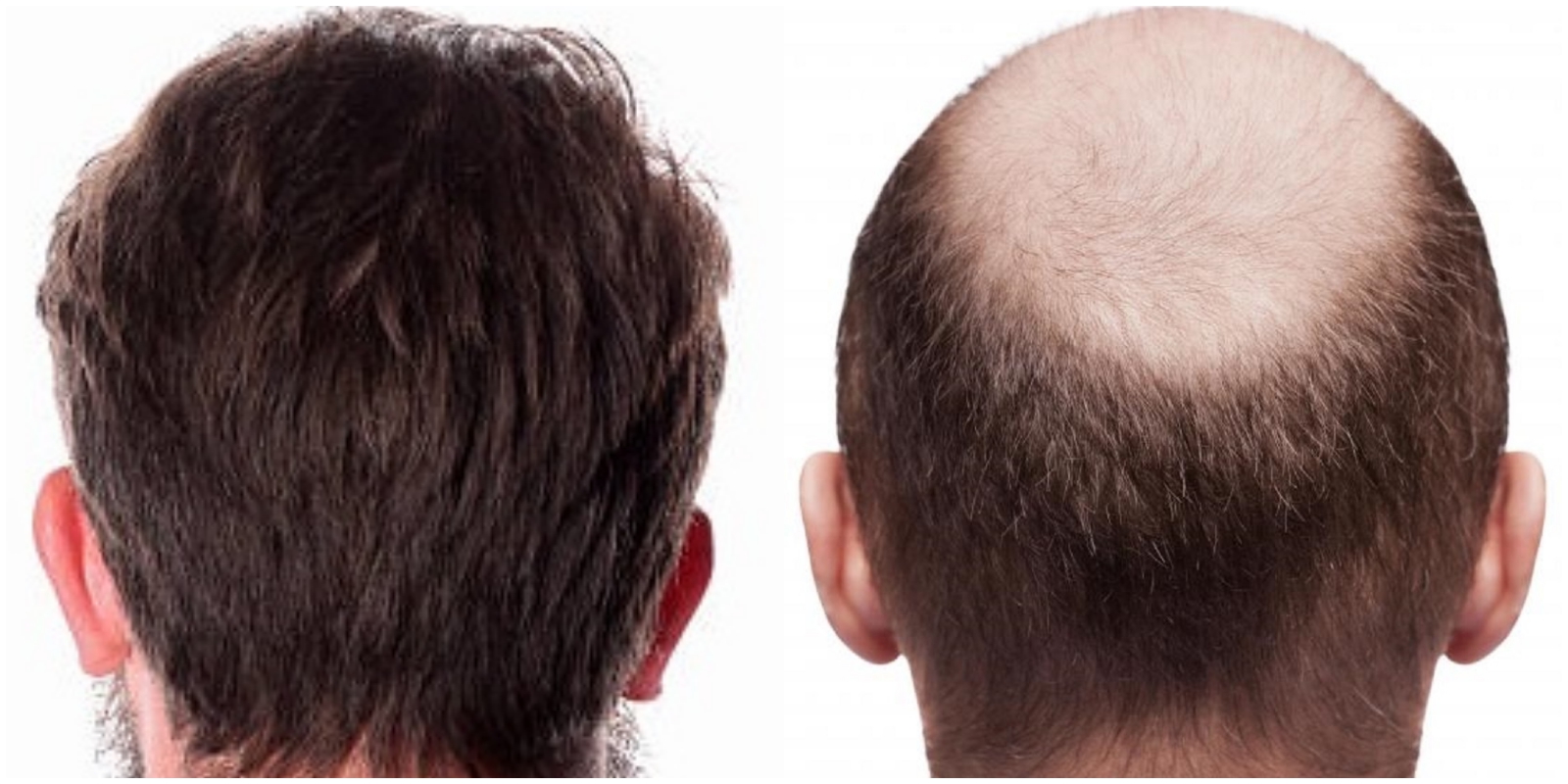 What is Safe Donor Area for Hair Transplantation - Vermont Republic